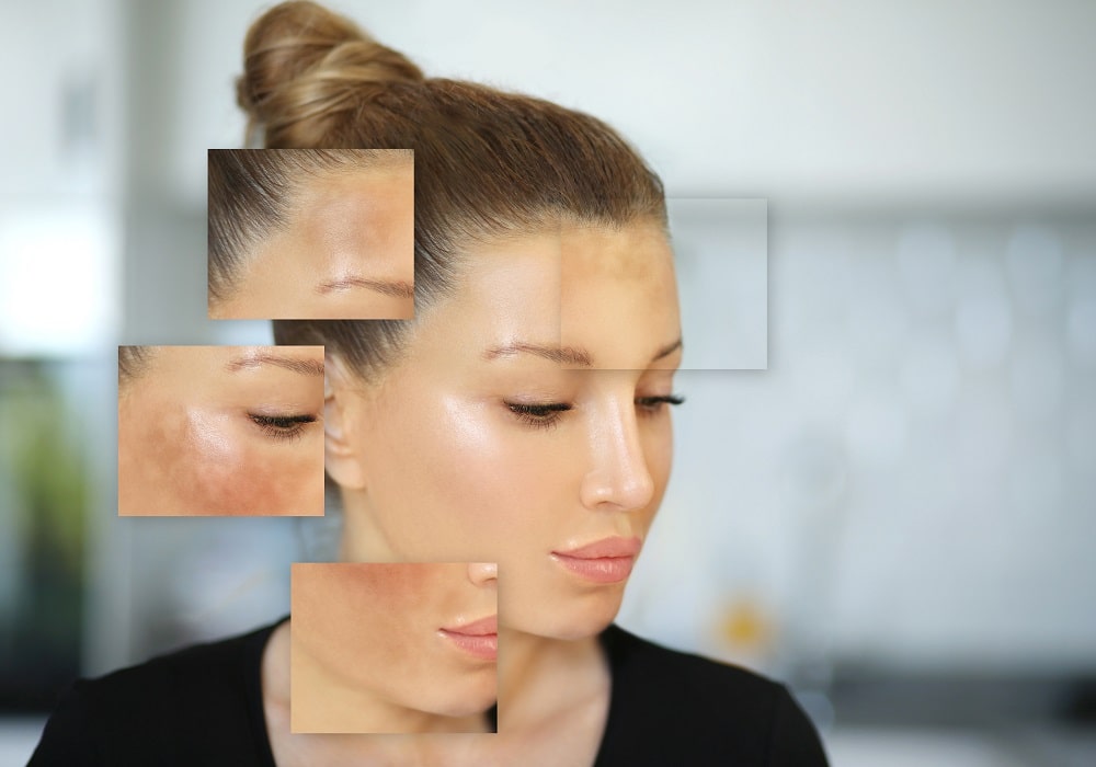 Melasma: entenda tudo sobre essa condição de pele